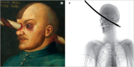 Impaled by comparison – Mind Hacks