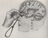 The hidden history of lobotomy’s non-inventor – Mind Hacks